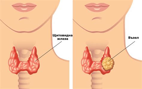 Актуално в Болница ВИТА Възли на щитовидната жлеза нодули защо и