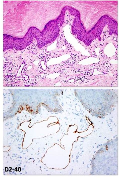 Lymphagioma Circumscriptum
