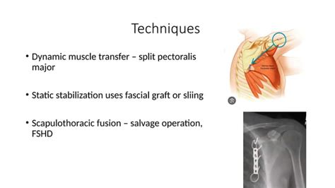 Scapular Dyskinesis Types And Management Pptx