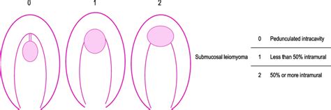 The International Federation Of Gynecology And Obstetrics Leiomyoma