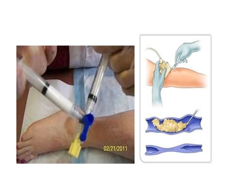 Recent Advances In Varicose Veins And Management Ppt