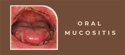 Managing Oral Mucositis Symptoms Causes And Treatments Clove Dental