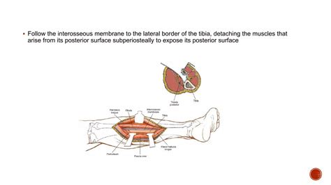 Proximal Tibia Surgical Approaches Pptx