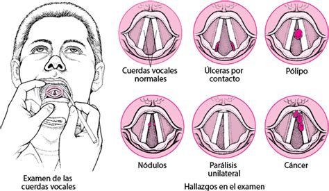 Image Trastornos De La Laringe Manual Merck Versión Para Profesionales