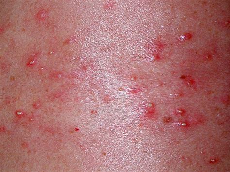 Dermatoweb Net