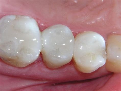 How Much Does A Tooth Filling Cost Atlas Dental