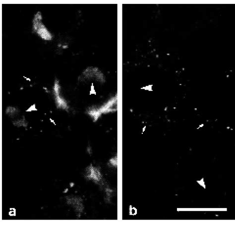 The Intracellular Distribution Of Aberrant Aggrecan Precursors Is