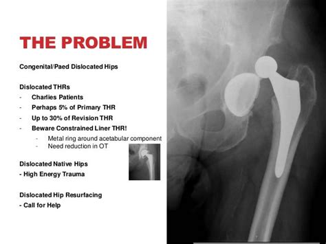 Hip Reduction Techniques