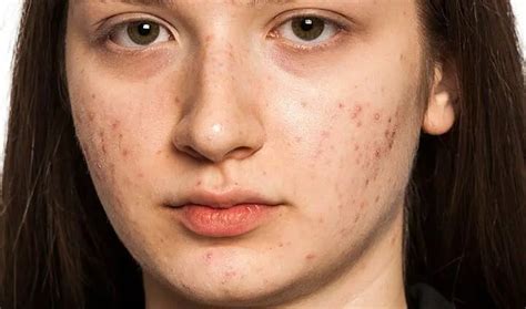 Facial Scar How To Remove Its Marks Video Healthy Food Near Me