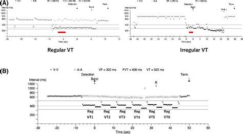 A Difference In The Cycle Length Variability Of VT The Left Panel Download Scientific