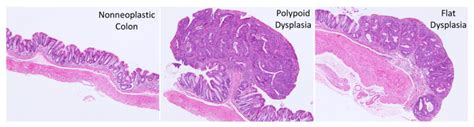 Low Power View Of Non Neoplastic Colon And Dysplasias In The Aom Dss