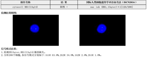 诊断多发性骨髓瘤？没那么简单！ 丁香园