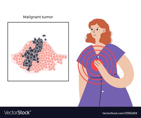 Tumor Cells Concept Royalty Free Vector Image Vectorstock