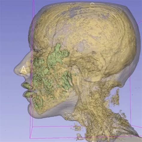Mri Of 33 Year Old Womans Face Reveals Where All Her Filler Went
