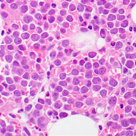 A Wright‐giemsa Stained Bone Marrow Aspirate Smear Original