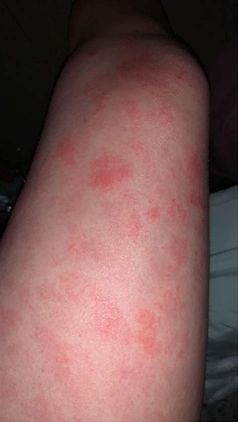 19f Had Anyone Elses Eczema Looked Like This When It Was Really Bad