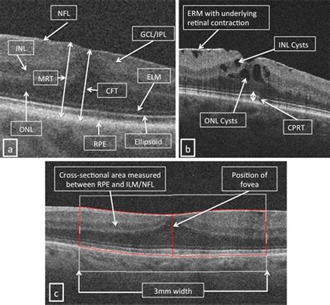 A B OCT Images Identifying Parameters Used In This Study C OCT Download Scientific