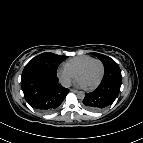 Choledocholithiasis And Choledochal Cyst Radiopaedia 79452 92568 Axial