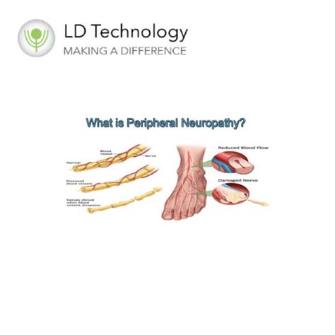 Peripheral Neuropathy Understanding The Nerves That Connect Us By