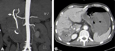 Computed Tomography Ct Angiography Shows Extravasation Of Contrast