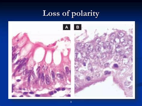 Neoplasia Grading And Staging Ppt