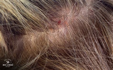 Scalp Inflammation Causes Symptoms And More Bee Choo Origin