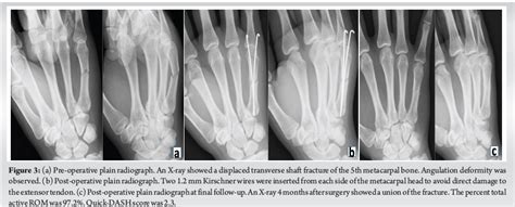 Clinical Outcomes Of Retrograde Percutaneous Pinning For Shaft Fracture Of Metacarpal Bone A