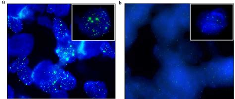 Telo Fish Analysis Of Telomere Length In Metastatic Mdbs Image Shows A