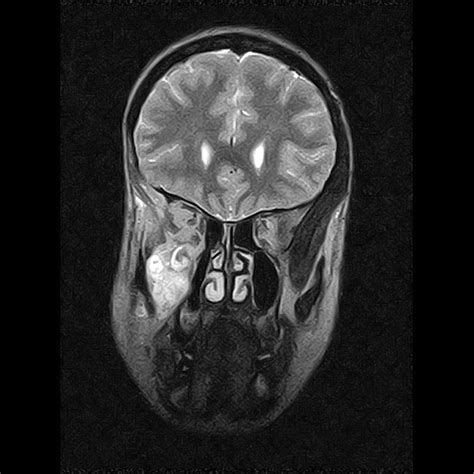 Plexiformes Neurofibrom Pacs
