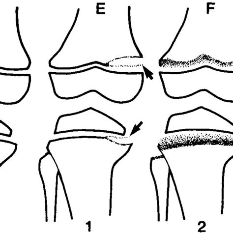 Pdf Radiographic Scoring Method For The Assessment Of The Severity Of Nutritional Rickets