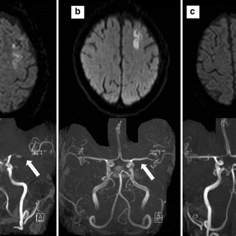Pdf Continuous Intra Arterial Nimodipine Infusion In Refractory