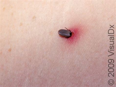 Normal Tick Bite Pictures Wisconsin Department Of Natural Resources