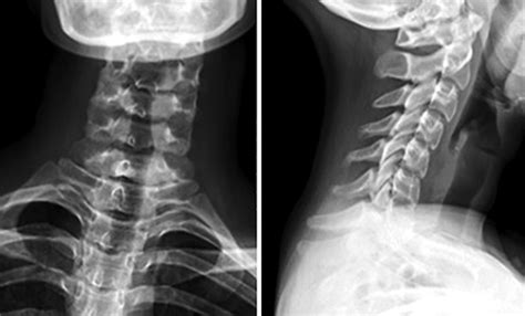 A Rare Case Of An Osteoid Osteoma Of The Cervical Spine Case Reports