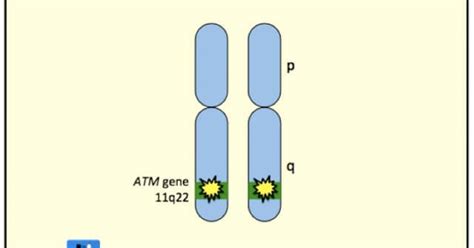 Ataxia Telangiectasia Image