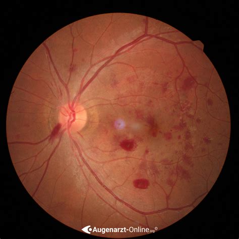 Fundus Hypertonicus Atlas Der Augenheilkunde