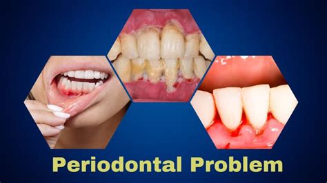 What Is Surgical Periodontal Treatment Doctor Suggestion