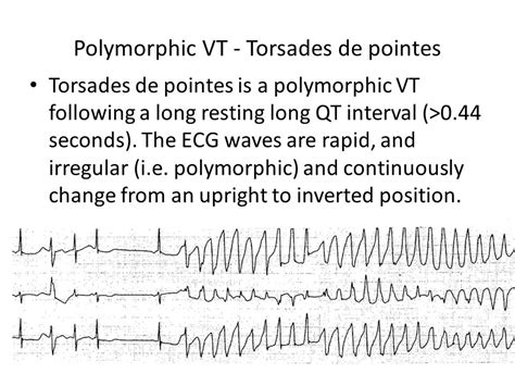 Ventricular Tachycardia Ppt Video Online Download