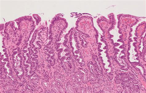 Gastritis Sonic Bookings