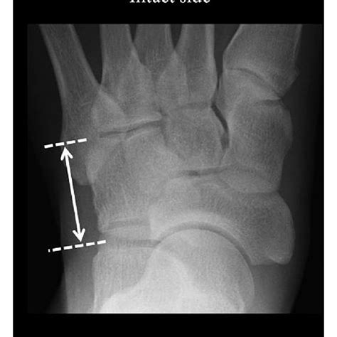Pdf A Case Report Of Isolated Cuboid Nutcracker Fracture