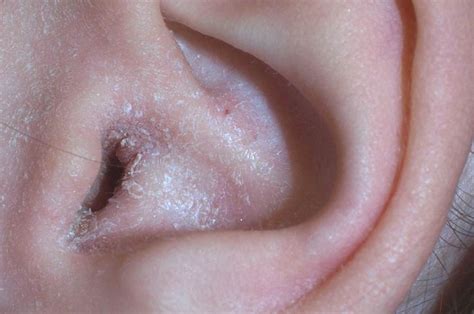 Ear Dermatitis Images Symptoms And Pictures