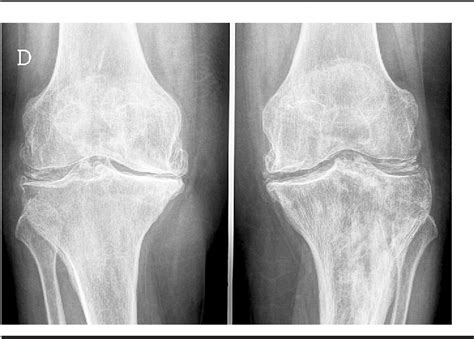 Chondrocalcinosis Wrist