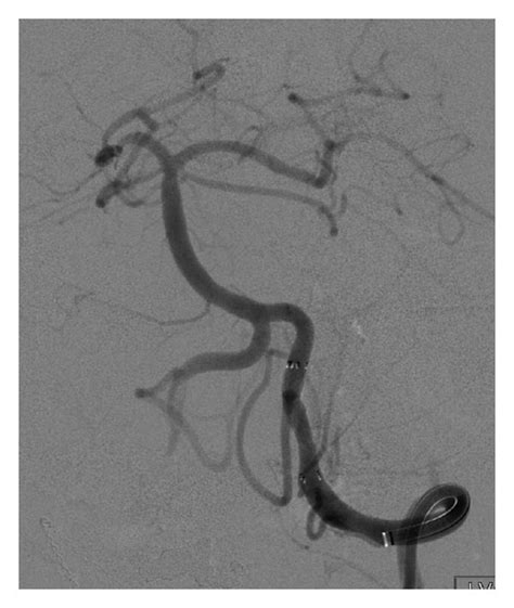 Left Vertebral Artery Angiogram Image Demonstrating Successful Stenting Download Scientific