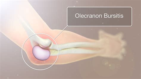 Olecranon Bursitis Shown And Explained Using Medical Animation Still Shot