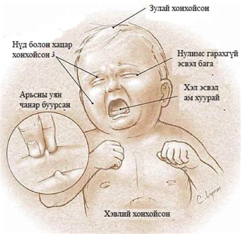 Суулгалт өвчний илрэх шинж тэмдэг урьдчилан сэргийлэх аргууд Niislel