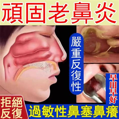 【反復老鼻炎】鼻塞鼻炎鼻竇炎鼻子過敏噴鼻劑鼻舒眠鼻那通噴鼻液改善鼻塞精油 蝦皮購物