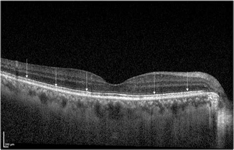 Ez On An Oct Image Obtained By Spectralis Oct White Arrows Indicate Ez