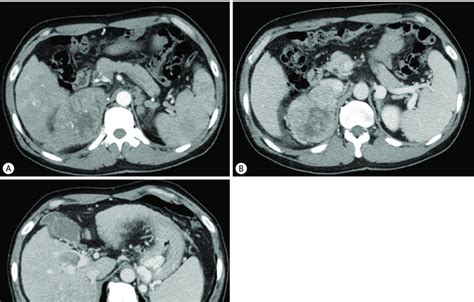 Liver Computed Tomography Ct Findings An Arterial Phase Image