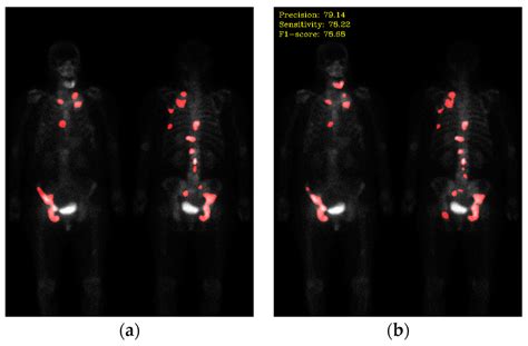 Diagnostics Free Full Text Bone Metastases Lesion Segmentation On