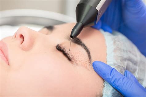 Jett Plasma Para Rejuvenescimento Das Pálpebras Medvisao Cirurgia