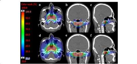 Isodose Curves For The Applied Hyperarc And Rapidarc Plans Clinical